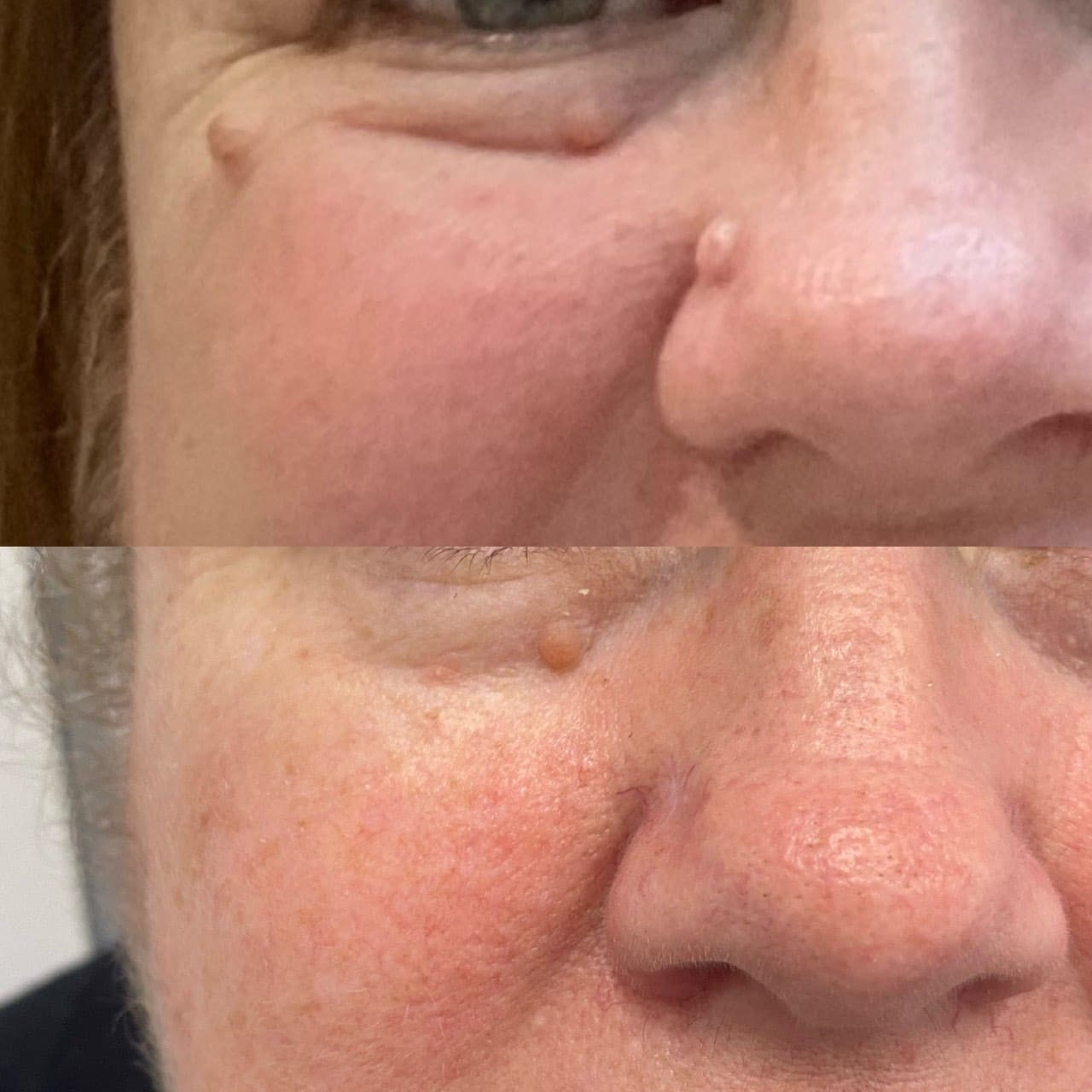 Cosmetic Mole Removal Brisbane