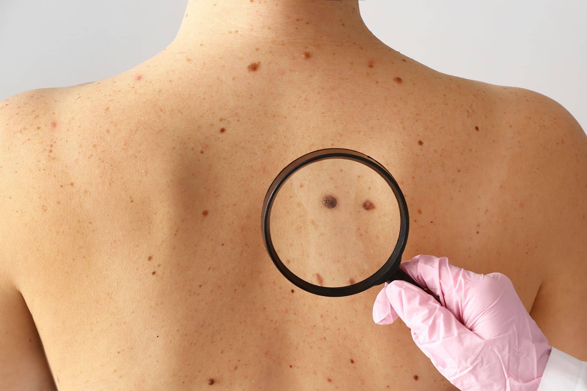How to Identify Skin Cancer: Early Signs You Shouldn’t Ignore