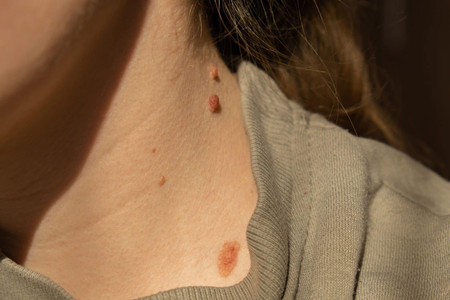 Non-Melanoma Skin Cancers: Basal vs. Squamous Cell Carcinoma