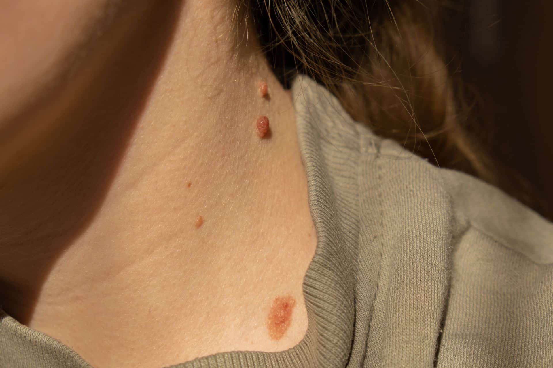 Non-Melanoma Skin Cancers: Basal vs. Squamous Cell Carcinoma